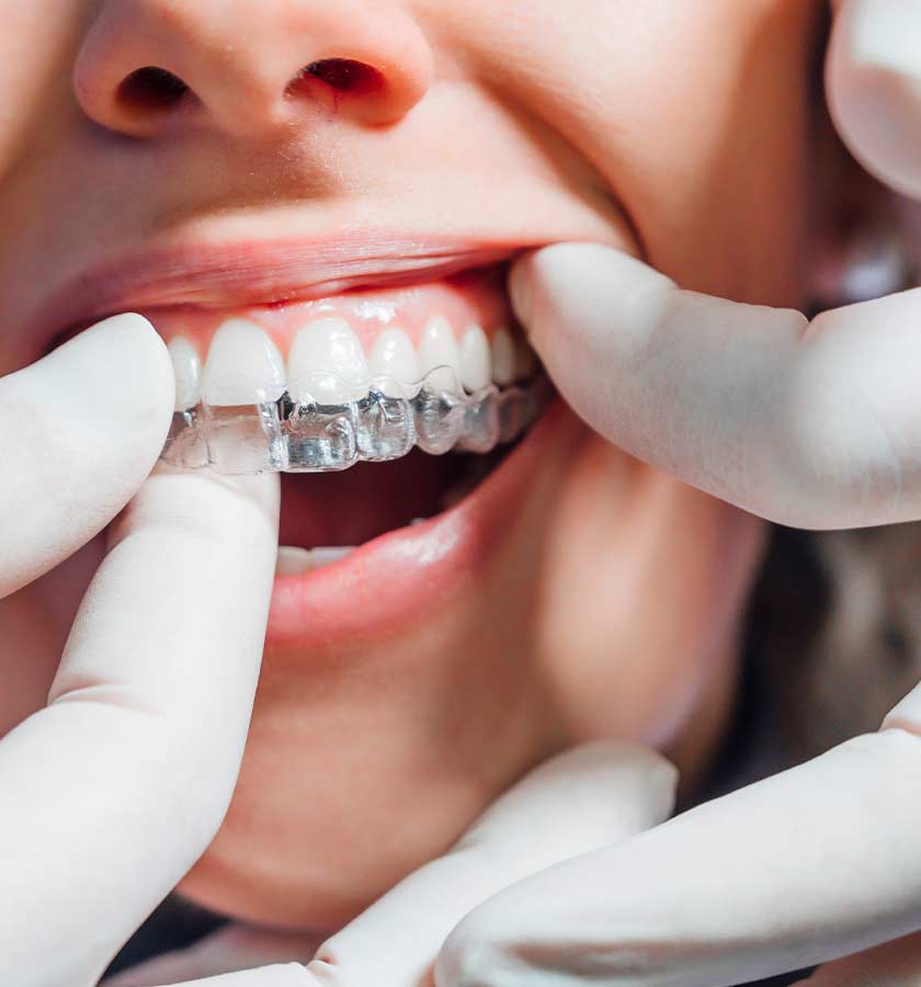 Zahnschienen – individuell angepasster Zahnschutz – Dr. Gal